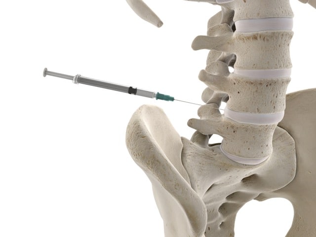 What are Cervical Facet Joint Injections | Rolling Hills Medical